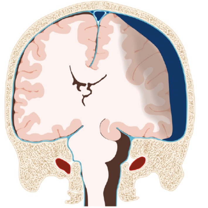 Eindelijk uitsluitsel over wel of niet opereren bij traumatische ...